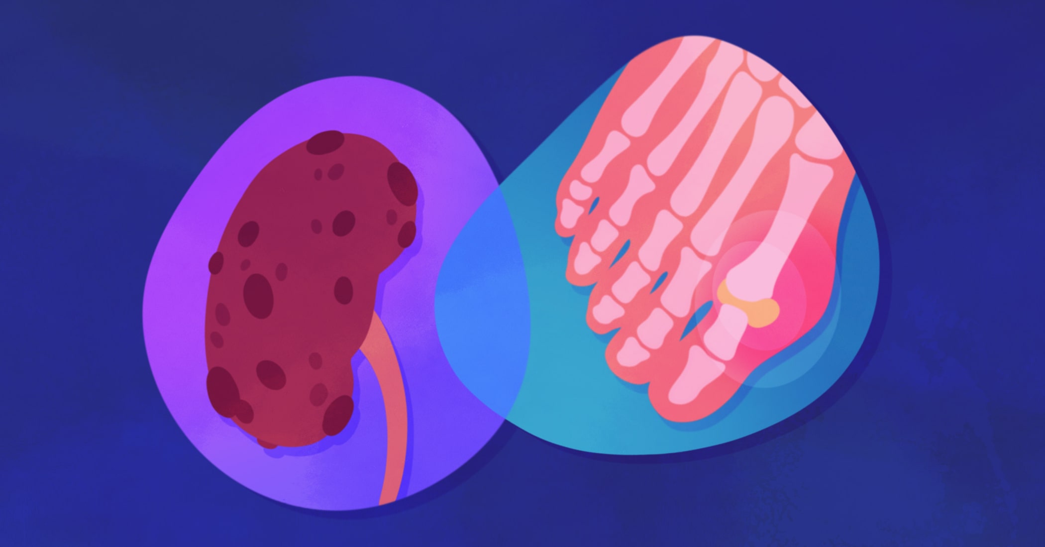 Gout and Its Link to Chronic Kidney Disease (CKD)